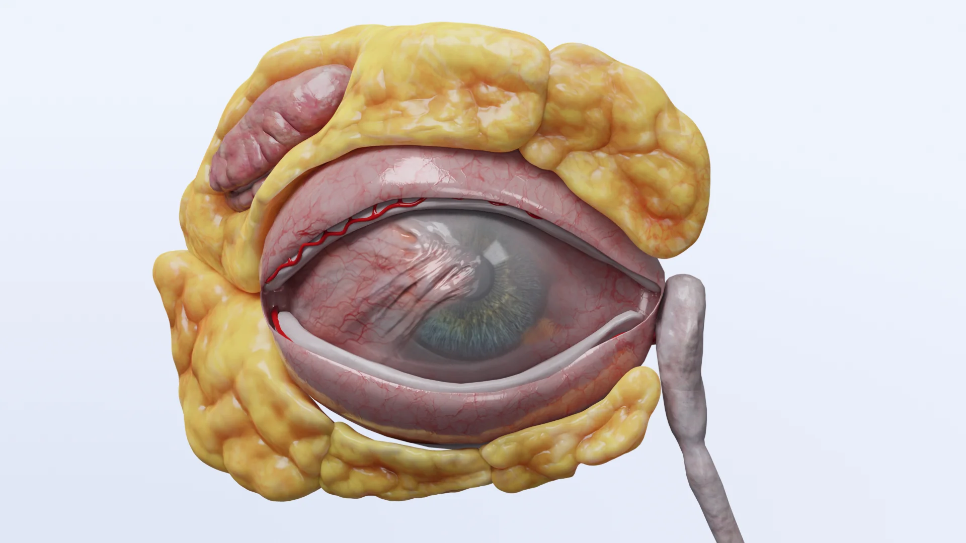 Pterygium: Definition, Causes, Severity, Diagnosis, Treatment